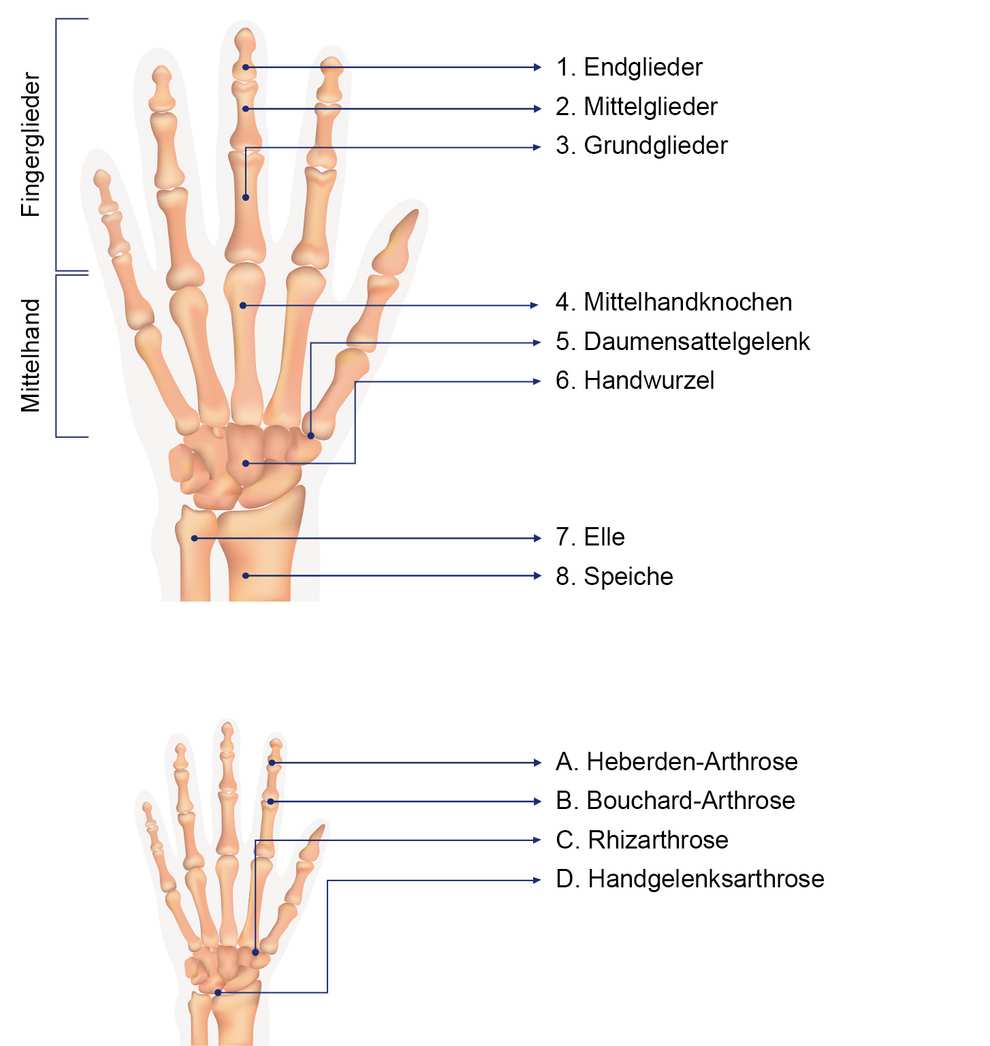 Hand- und Fingerarthrose: Überblick | Arthrose