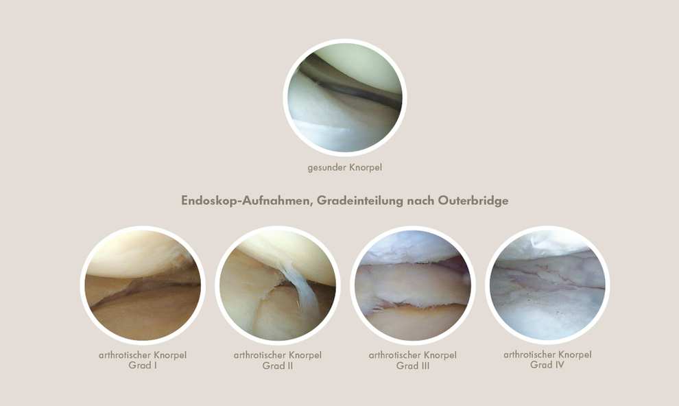 Arthrose: Ursachen | Arthrose